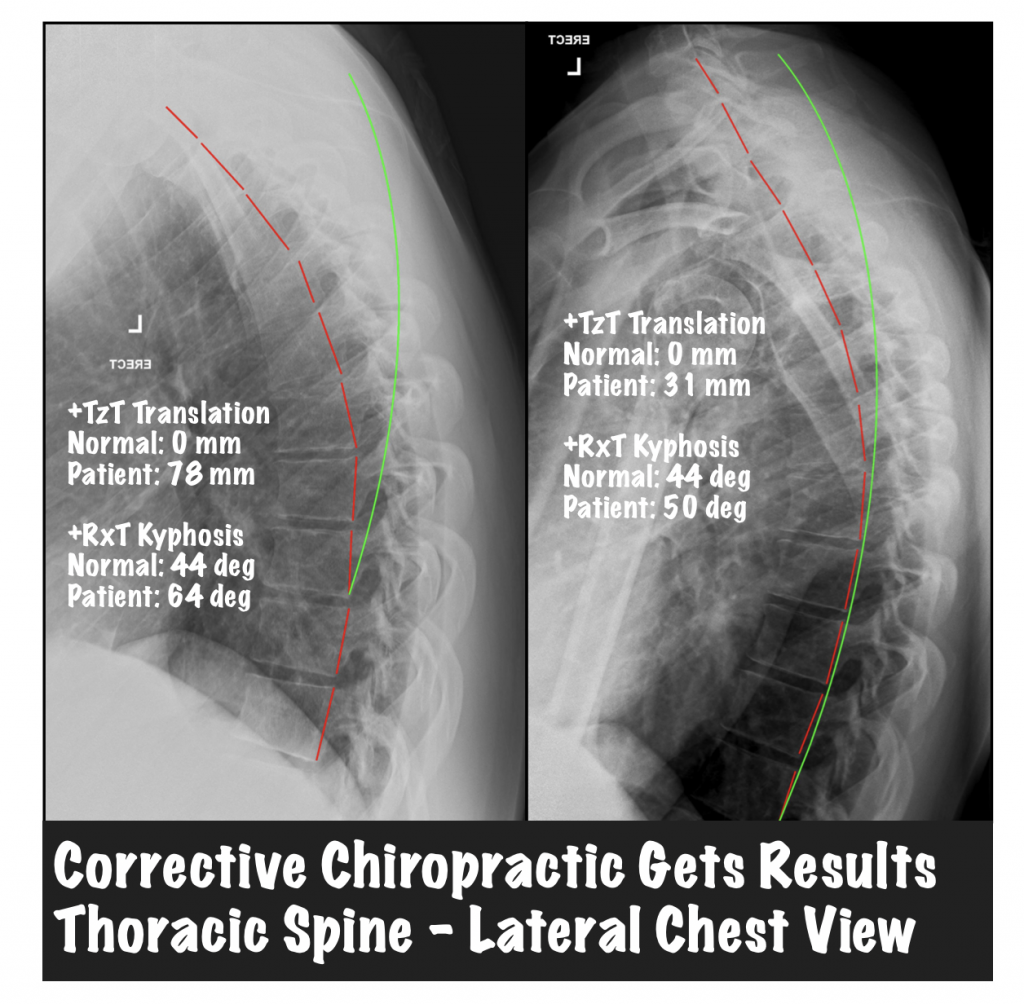 Correcting Chronic Low Back Pain and American Posture