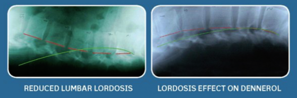 Denneroll Spinal Orthotics For Curve Correction - The Spinal Centre